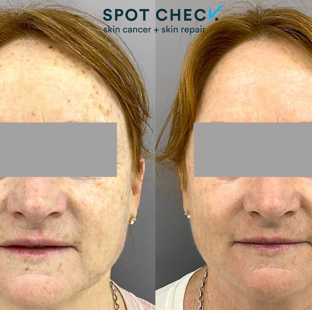 Angioma | Spot Check: skin cancer + aesthetics. Melbourne CBD