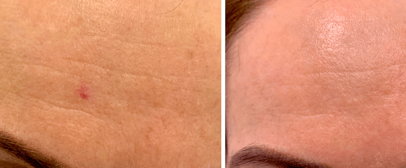 Angioma | Spot Check: skin cancer + aesthetics. Melbourne CBD