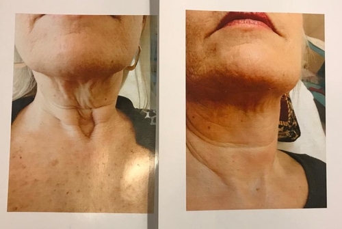 Botox
