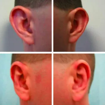 Otoplasty, Pinnaplasty (Ear Pinning) | Birmingham