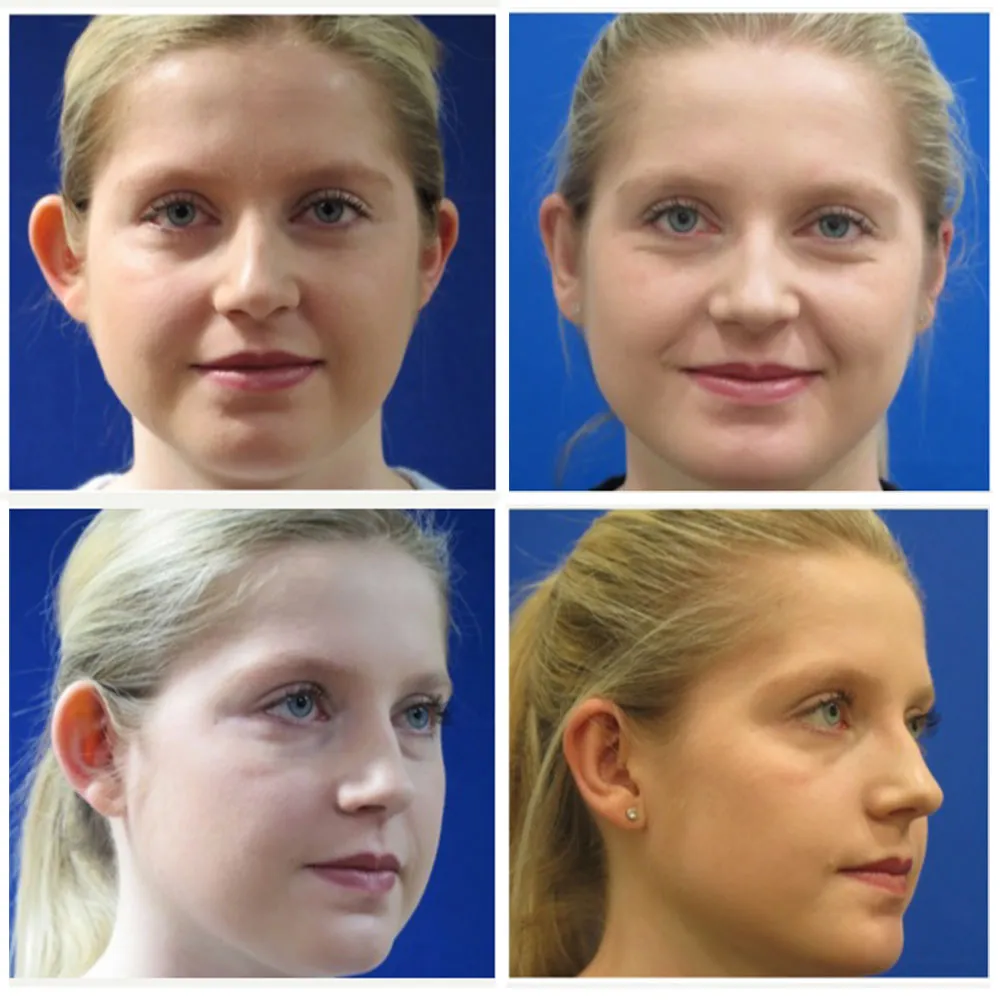 Otoplasty, Pinnaplasty (Ear Pinning) | Birmingham