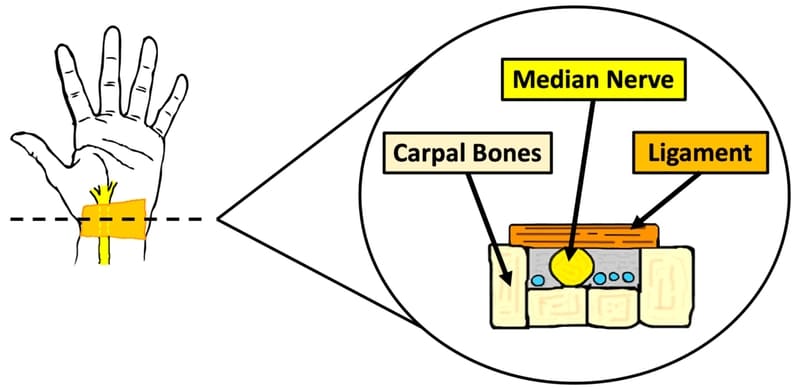 Carpal tunnel decompression | Clare House Surgical & Dermatology