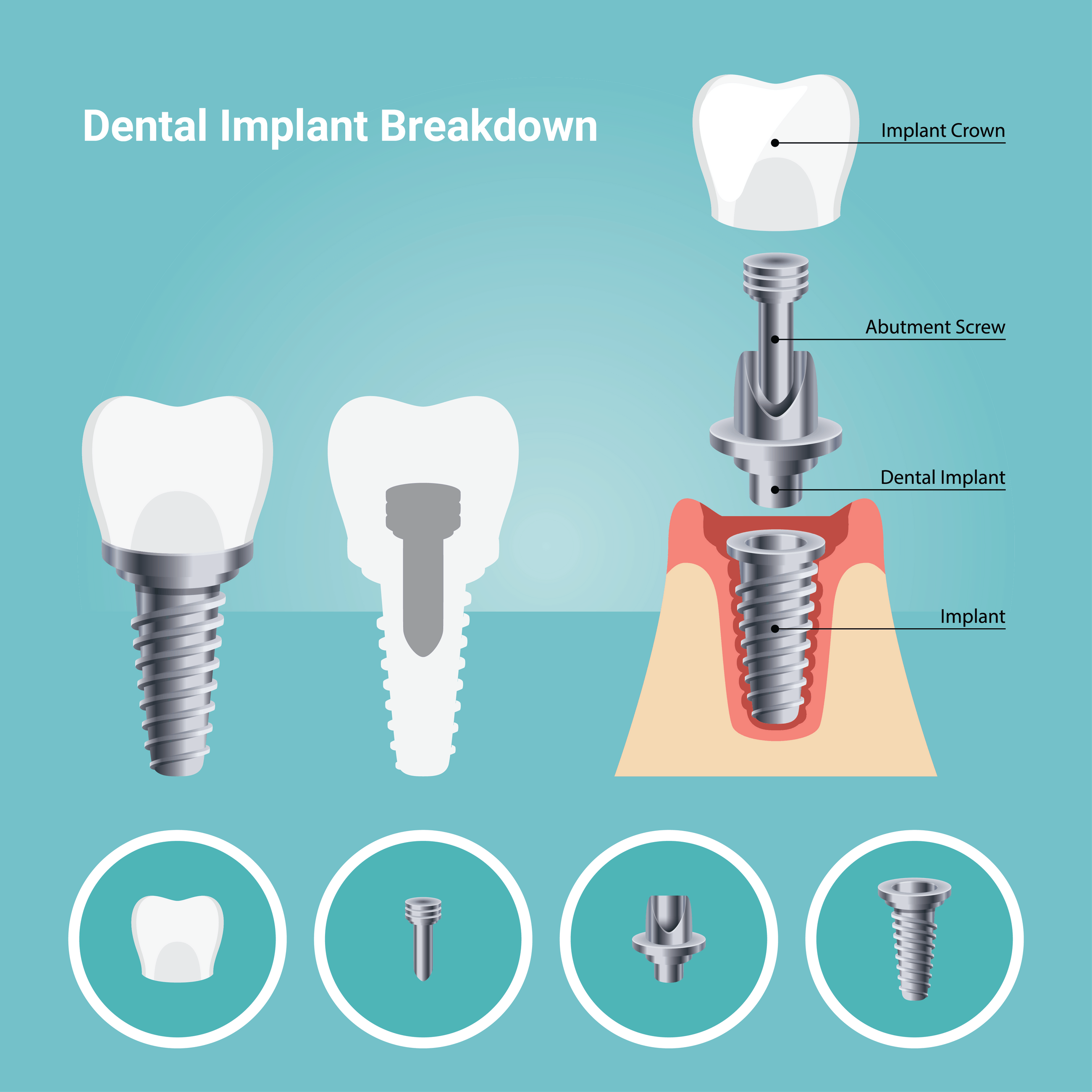Article - 2020 Dental Implant Guide