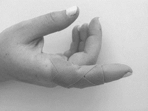 Dislocations | The Hands Physio