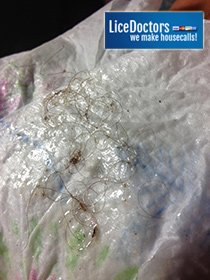 A Brief History of Lice Treatments | LiceDoctors