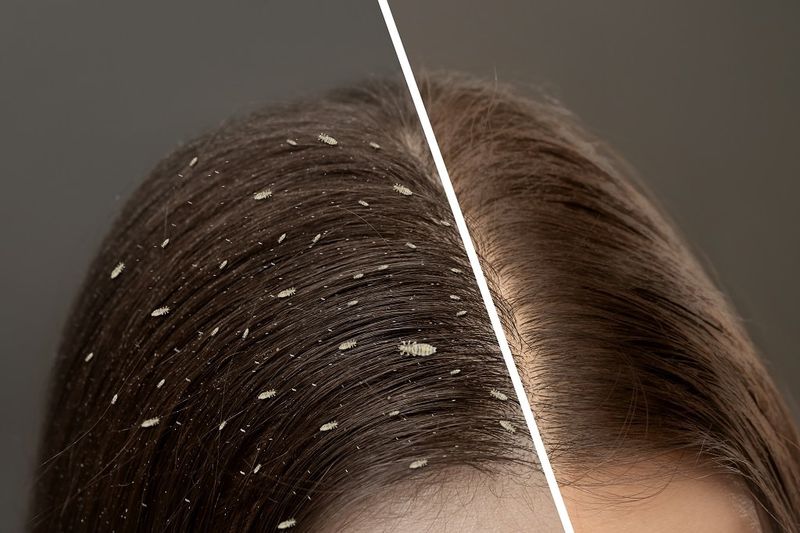 How to Get Rid of Lice Naturally in One Day | LiceDoctors | LiceDoctors