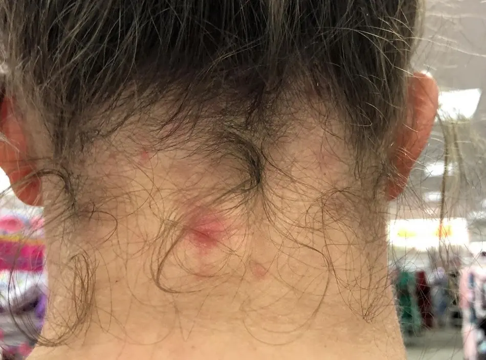 Lice Sores: How Do You Heal Them? | LiceDoctors