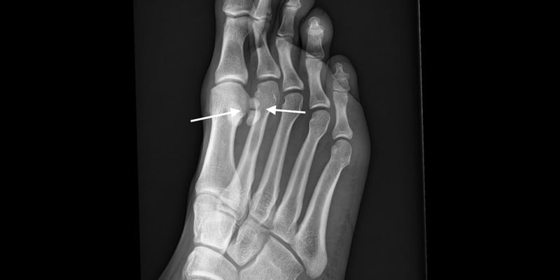 Radiology Review - Sesamoid fracture | Axis Sports Med