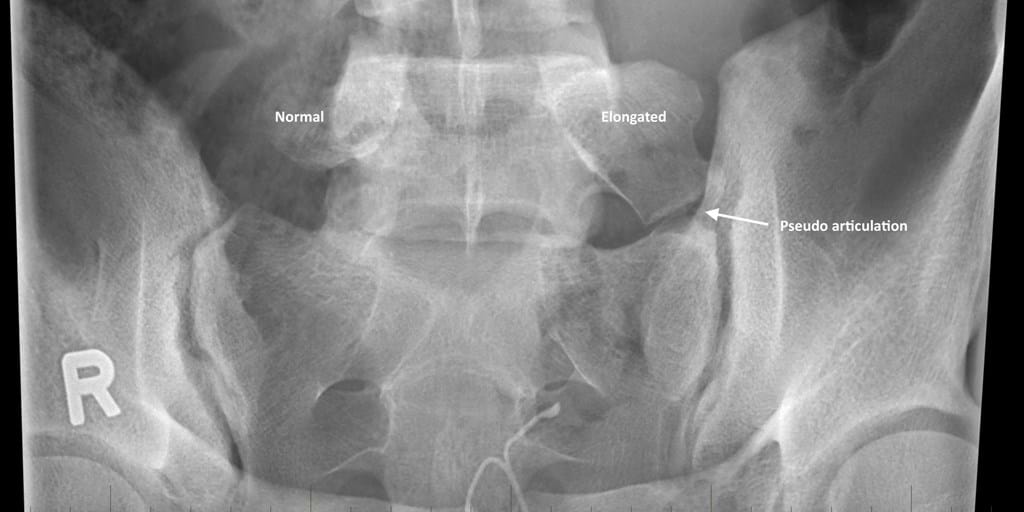 Radiology review: Bertolotti's Syndrome | Axis Sports Med
