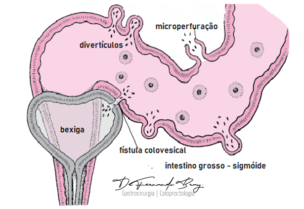 O que é Diverticulite? - Dr Fernando Bray