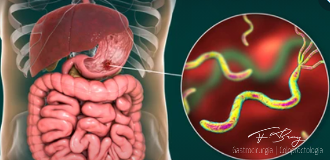 GASTRITE: O que é, Causas e Como Tratar - Dr Fernando Bray