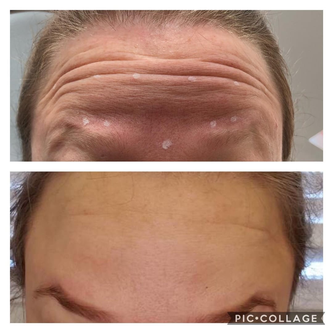 Botox In Collingwood | LYFT Medical Aesthetics