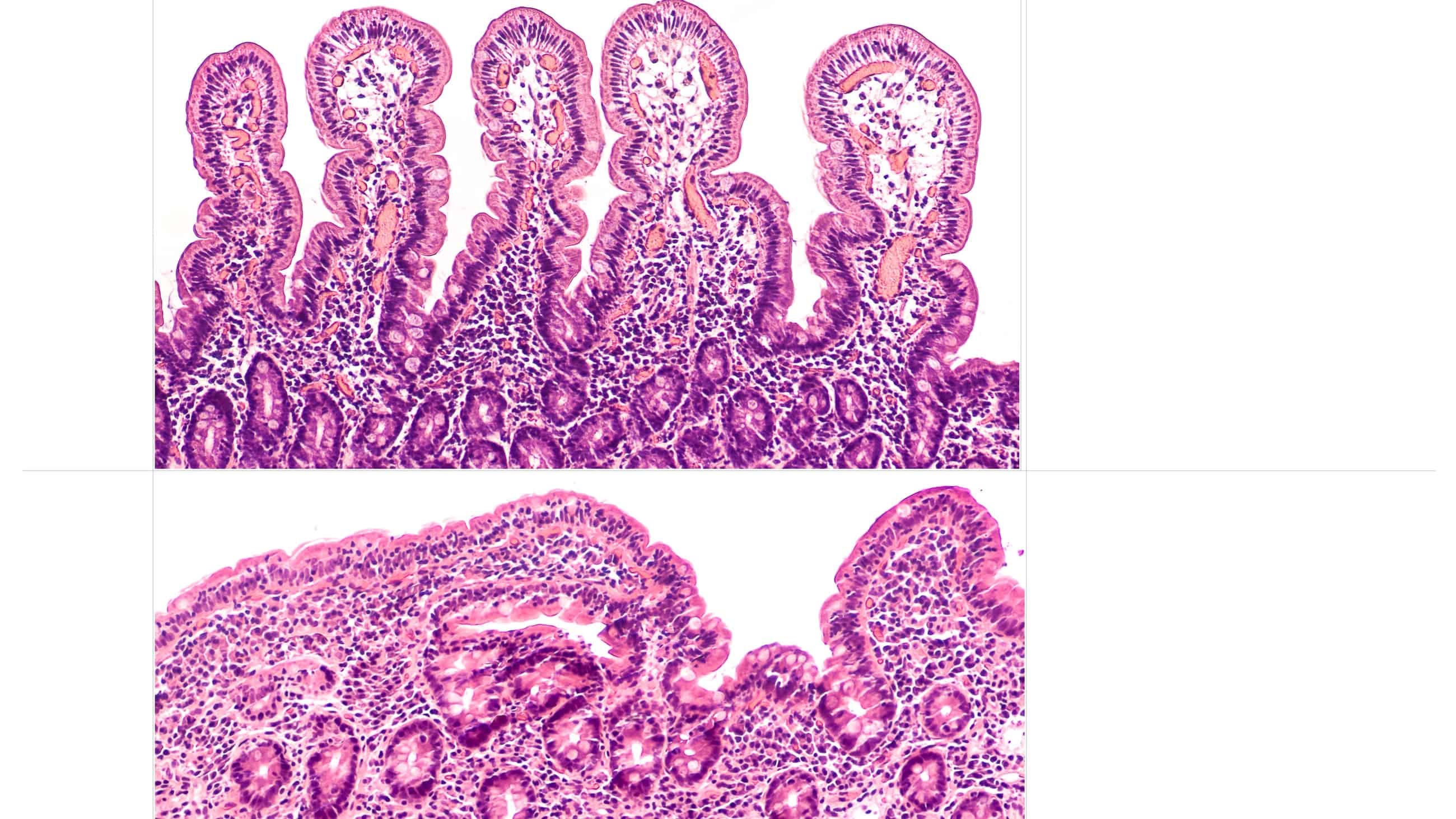 Coeliac disease - Diet Solutions
