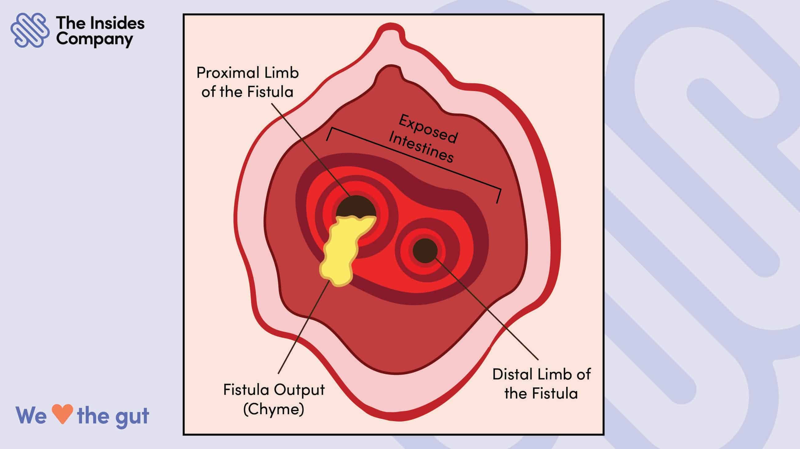 What is an Enterocutaneous Fistula and Enteroatmospheric Fistula?