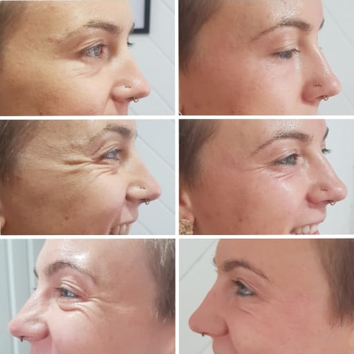 Sa Vie Skin Spa · Plasma Pen Facelift and Body