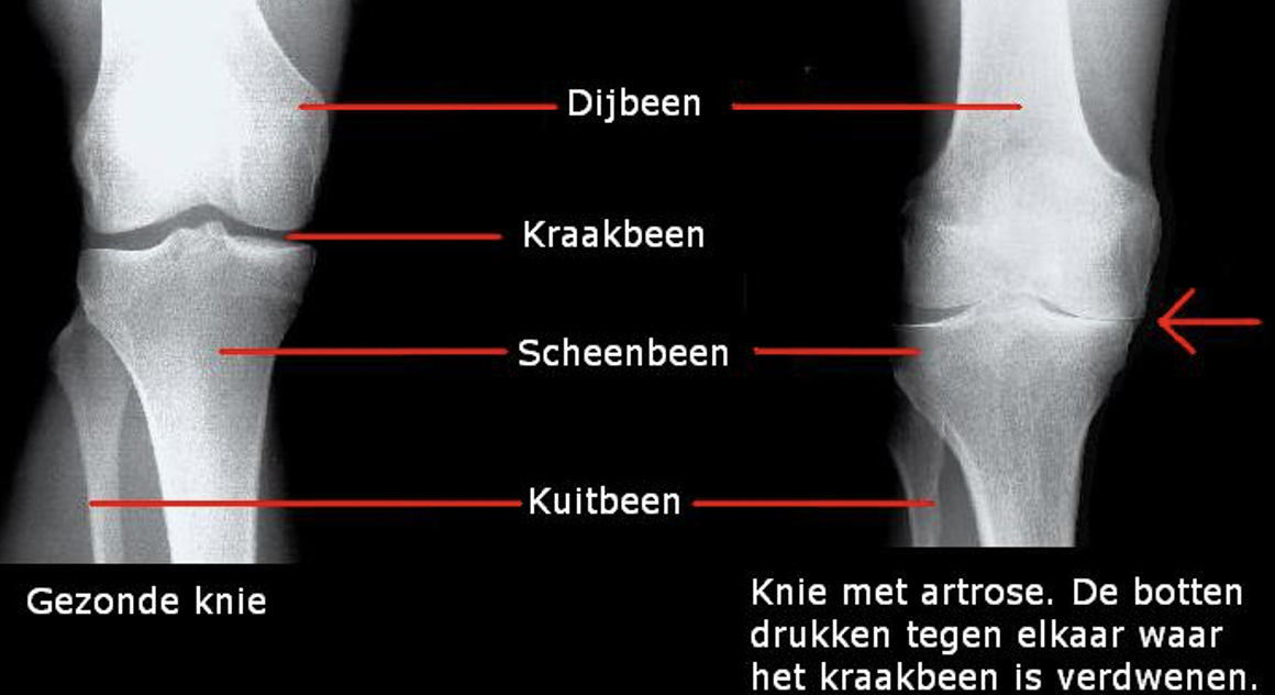 Artrose van de knie | Orthoteam Limburg