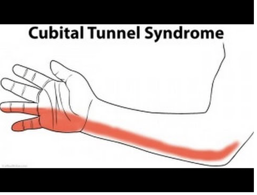Inklemming van de nervus Ulnaris (cubital tunnel syndroom) | Orthoteam ...
