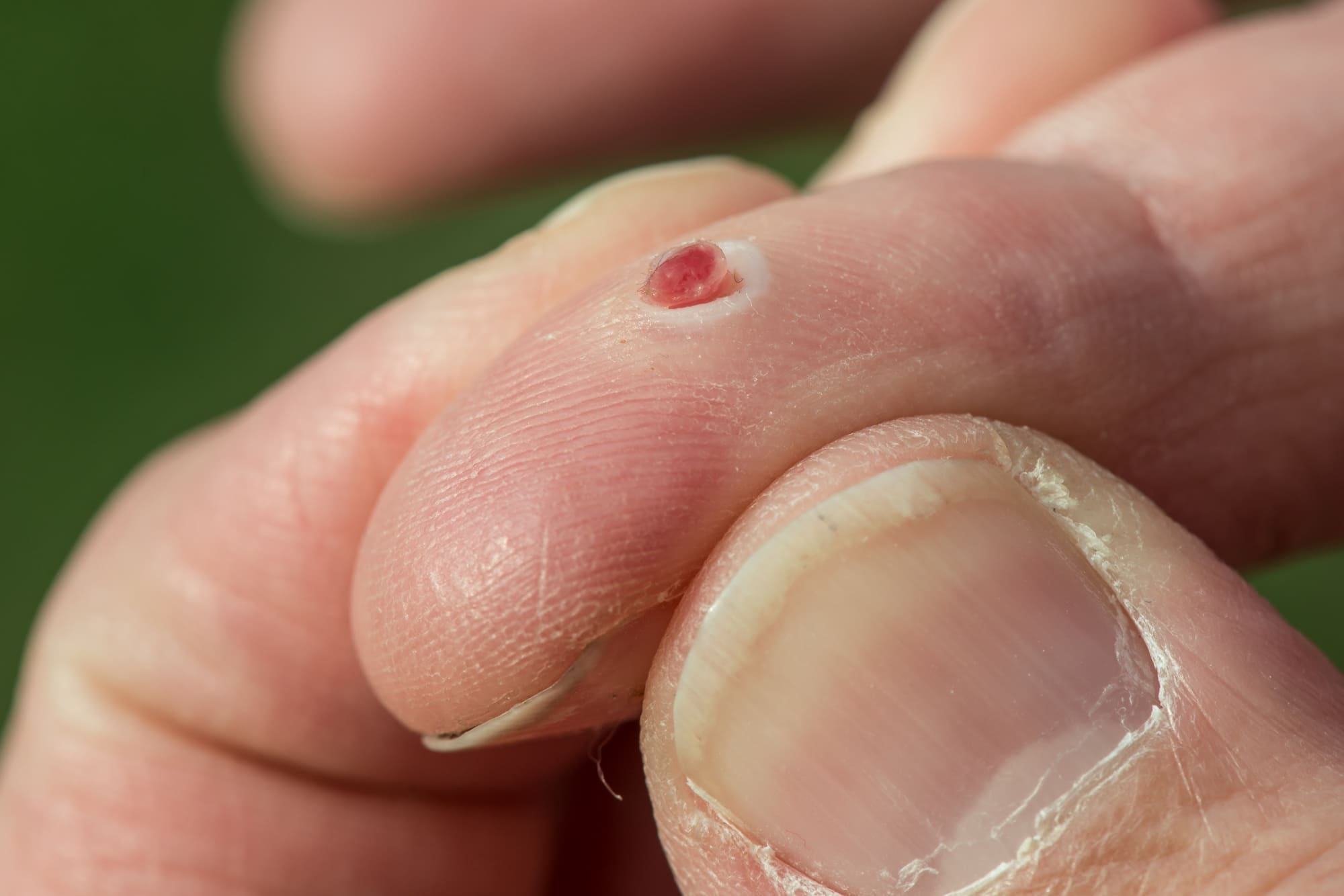 Pyogenic Granuloma Removal | Pyogenic Granuloma Treatment