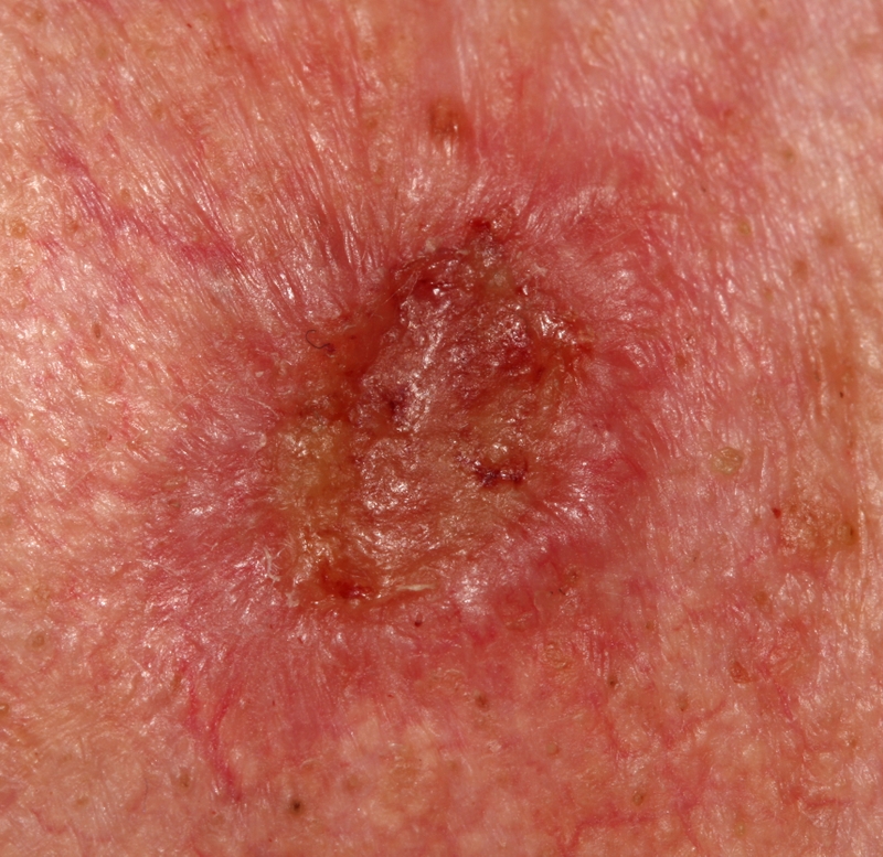 Squamous Cell Carcinoma Surgery Toronto - TMSC
