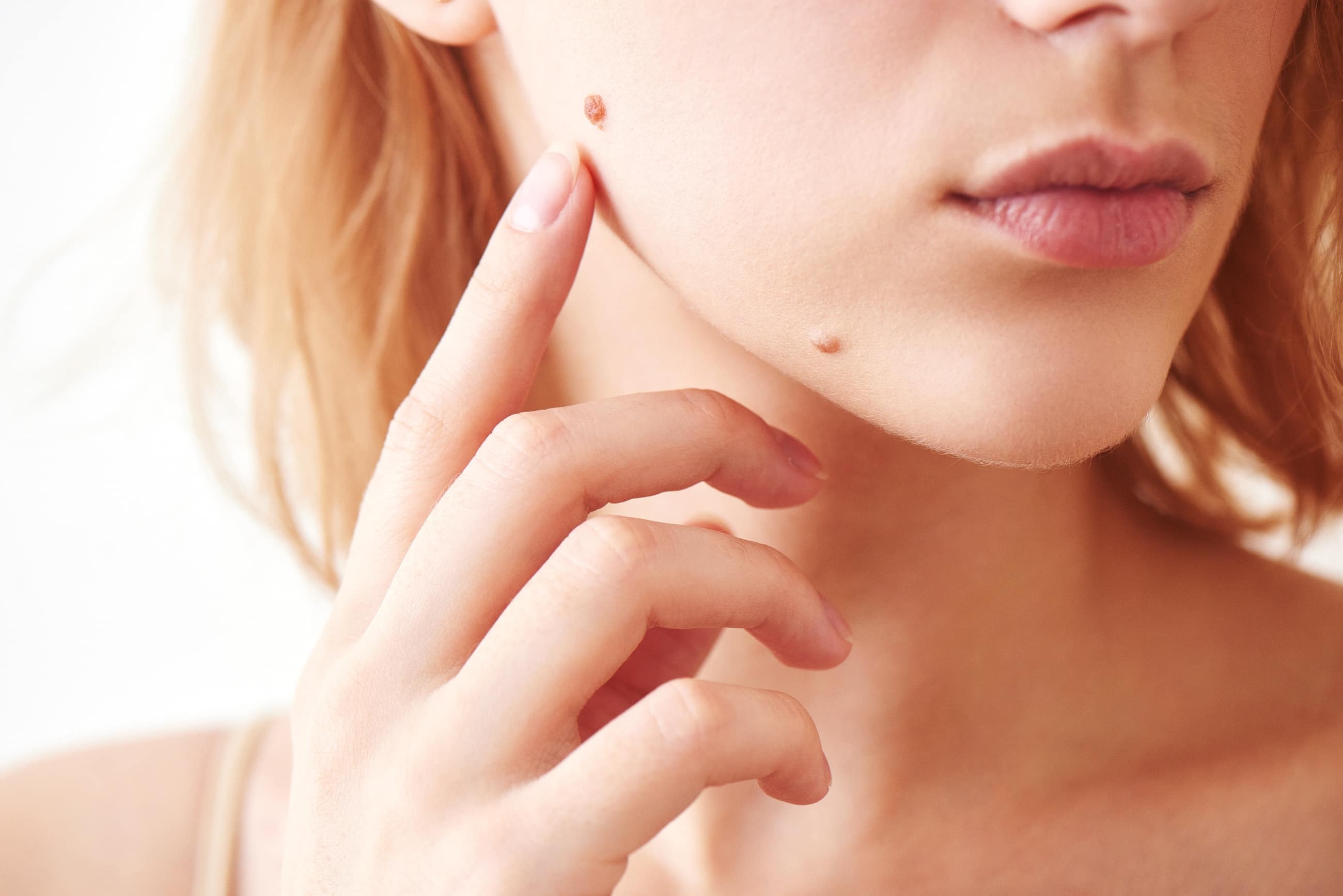 Toronto Mole Removal | Mole Surgery & Treatment