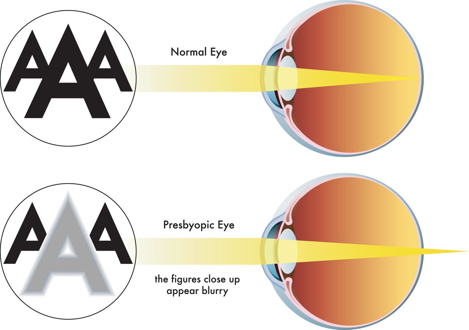 LASIK for Presbyopia in Chicago | Kraff Eye Institute