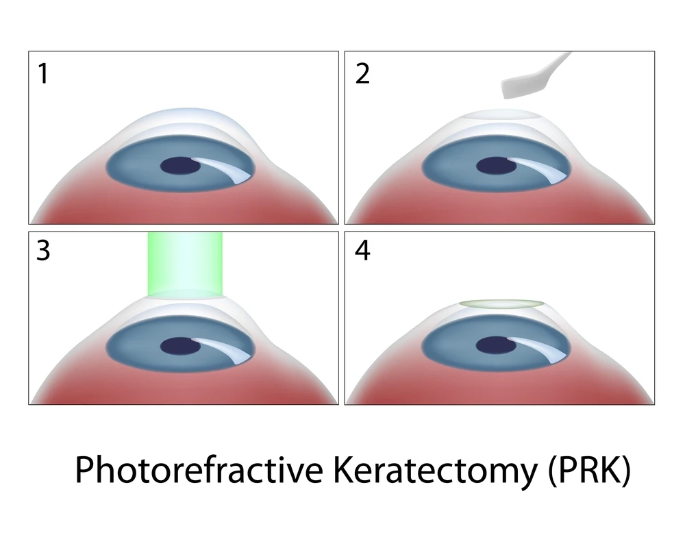 Custom PRK Surgery in Chicago, IL | Kraff Eye Institute