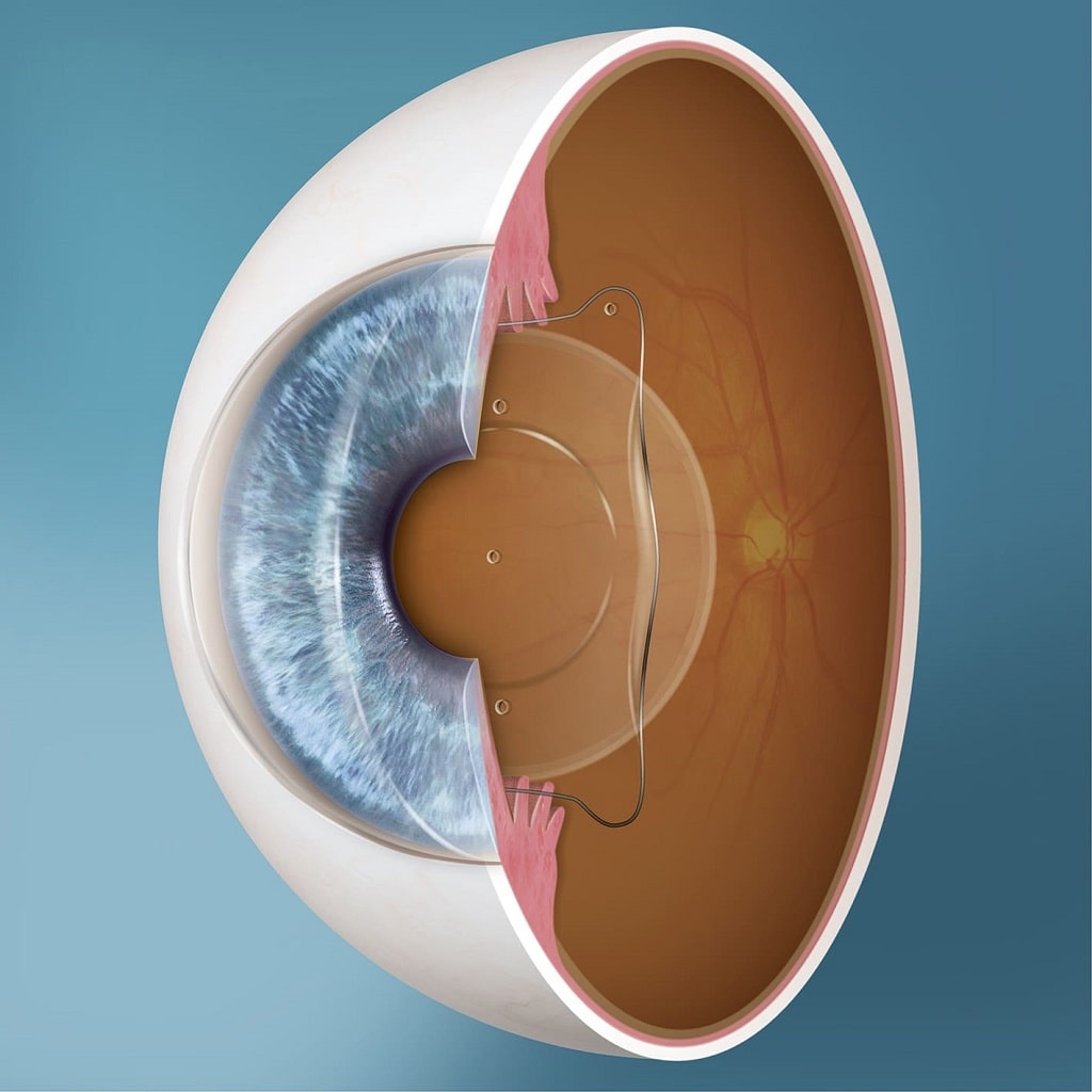 Implantable Collamer Lens (ICL) in Chicago | Kraff Eye Institute