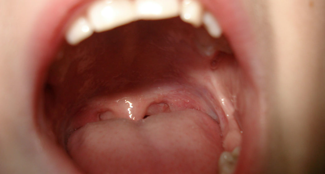 Throat Irritation From Post Nasal Drip