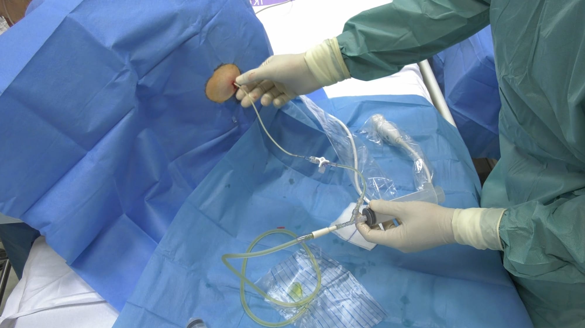 Workflow Blog: Pleural drainage (Thoracocentesis)