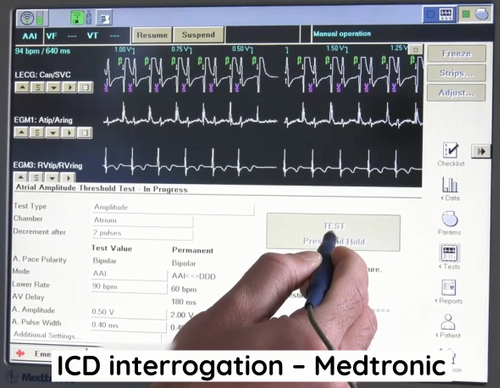 Workflow Blog: ICD interrogation - Medtronic