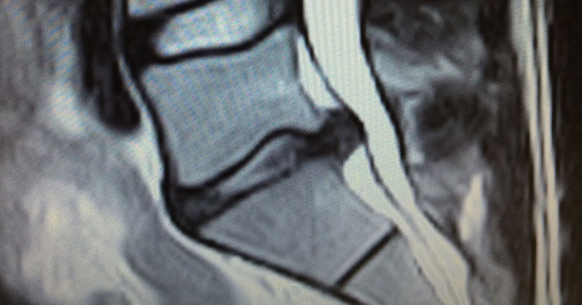 Is an MRI for lower back pain really necessary?