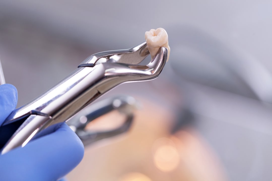 Learn How to Care for Your Mouth After a Tooth Extraction