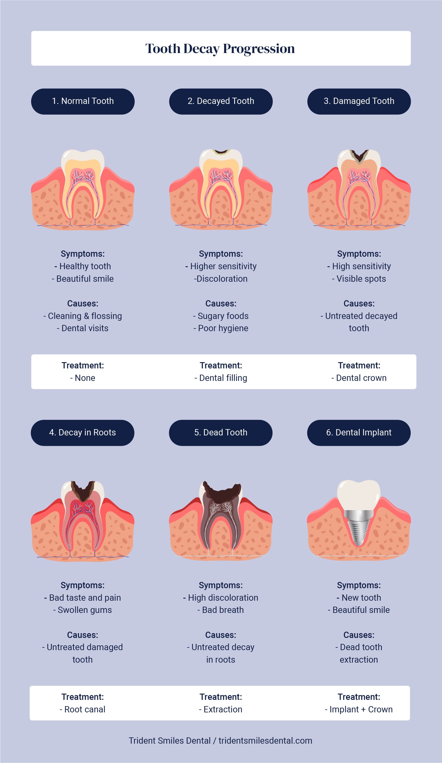 Trident Smiles Dental | The various stages of tooth decay (with ...