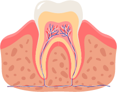 Trident Smiles Dental | The various stages of tooth decay (with ...