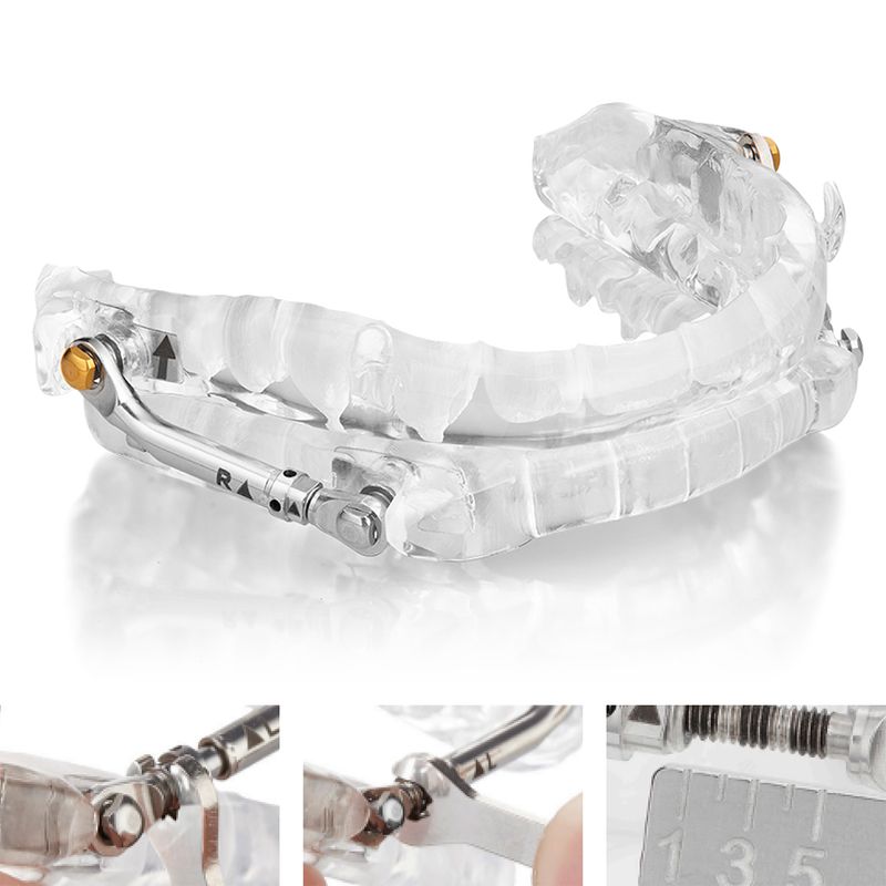 Titrate FDA-Approved Oral Appliance for Sleep Apnea | BlueSleep