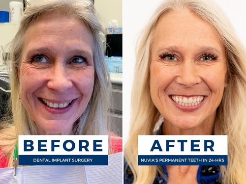 Nuvia Dental Implant Center | Dental Implants in 24Hrs
