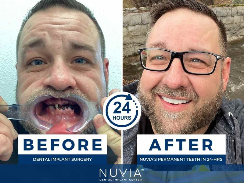 24 Hour Dental Implants Nashville TN| Nuvia Dental Implant Center