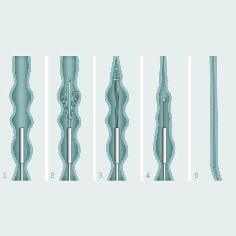 UK Vein Clinic | Blog | Veinwave Treatment For Thread Veins: Non ...