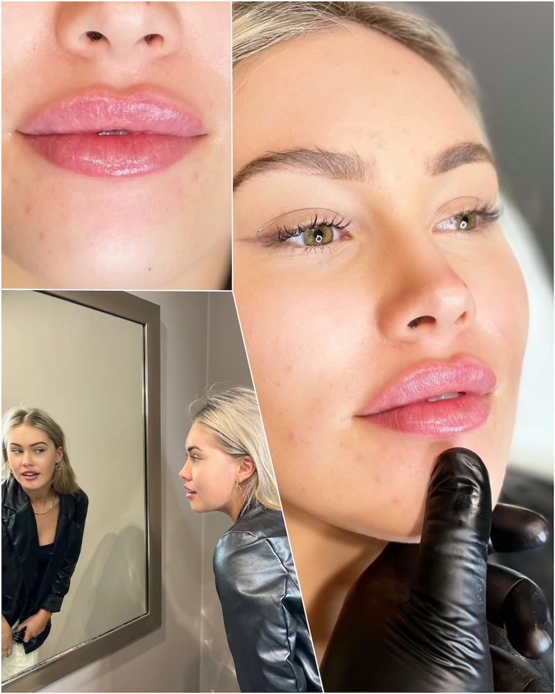 Russian Lip Filler Before and After