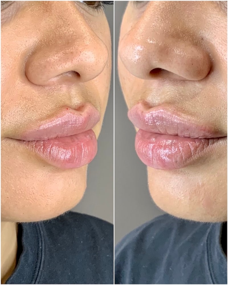 Russian Lip Filler Before and After