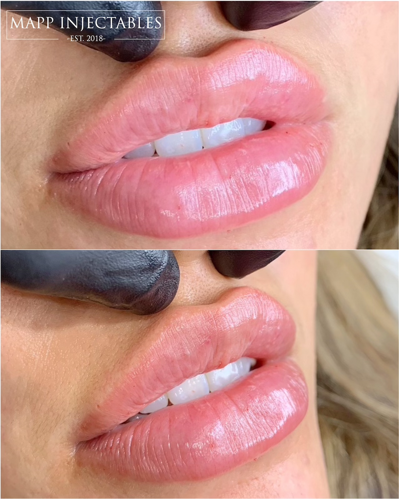 Russian Lip Filler Before and After