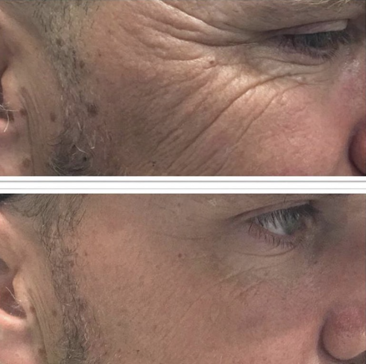 Crows-Feet Before and After