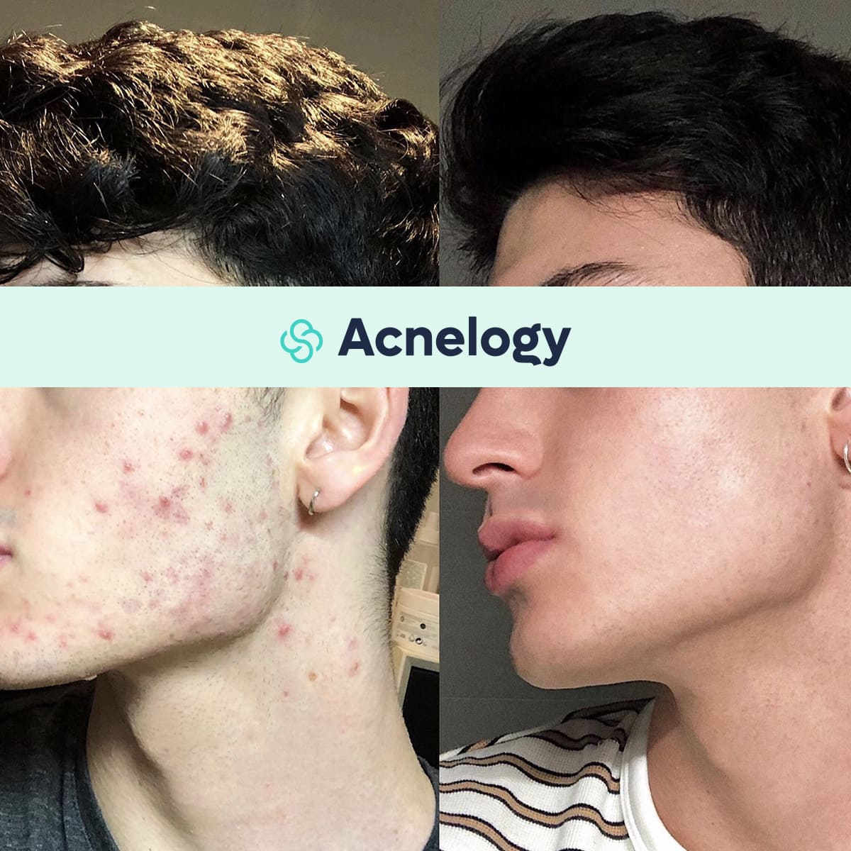 Clínica especializada de tratamientos de acné | Acnelogy