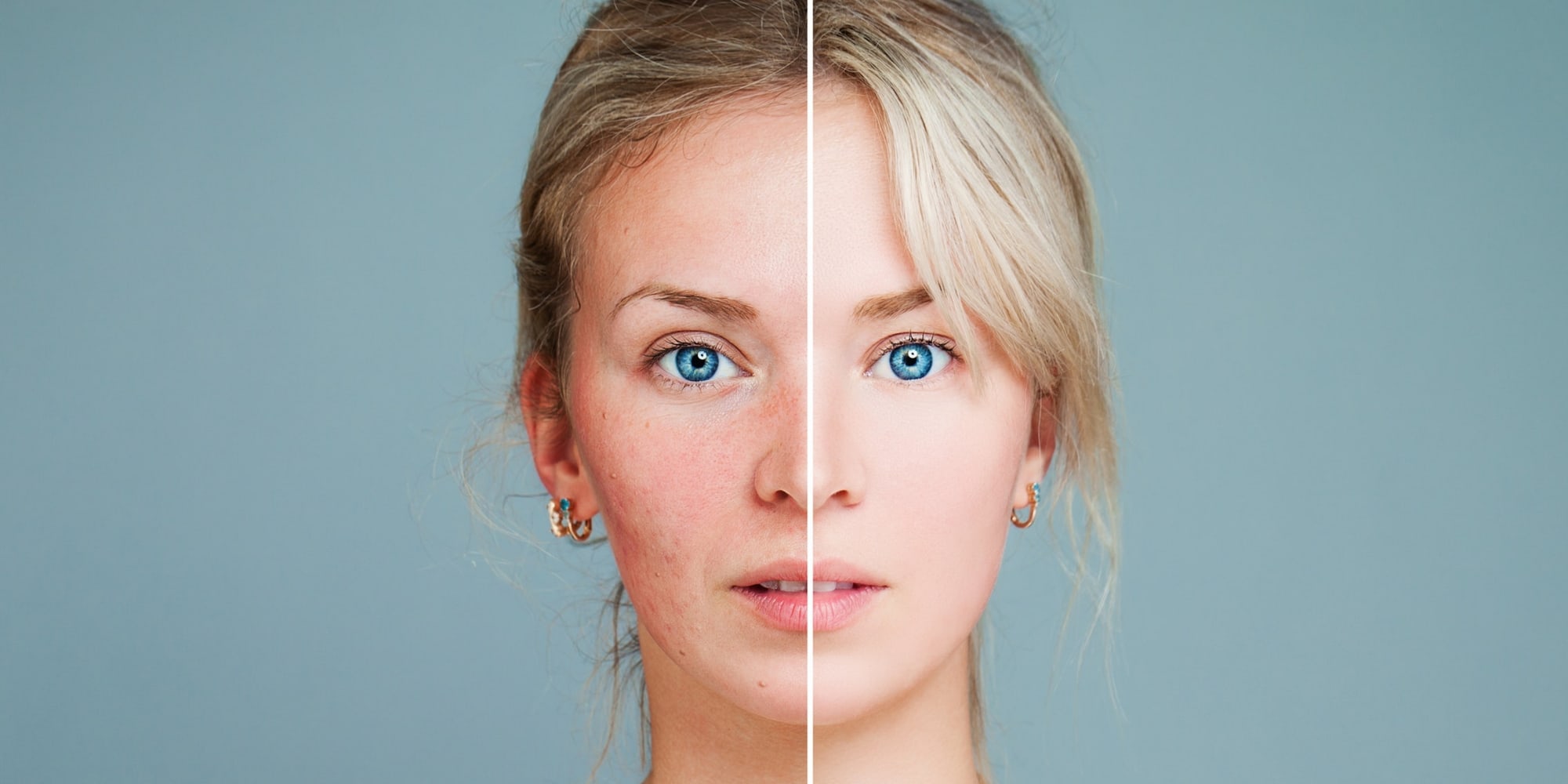 Rosacea Treatment | Qutis Clinics