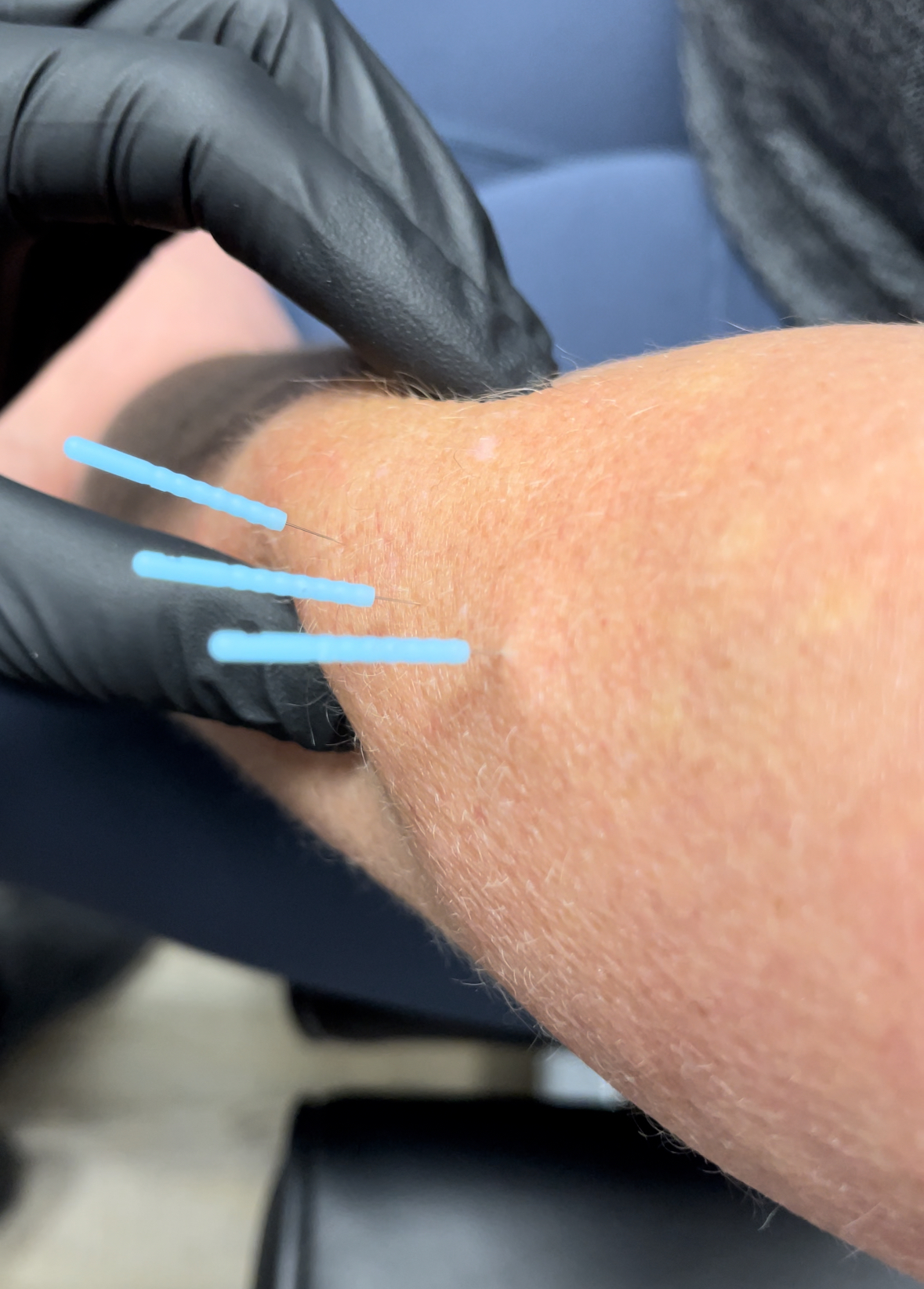 Dry Needling for Management and Treatment of Myofascial Trigger Points ...