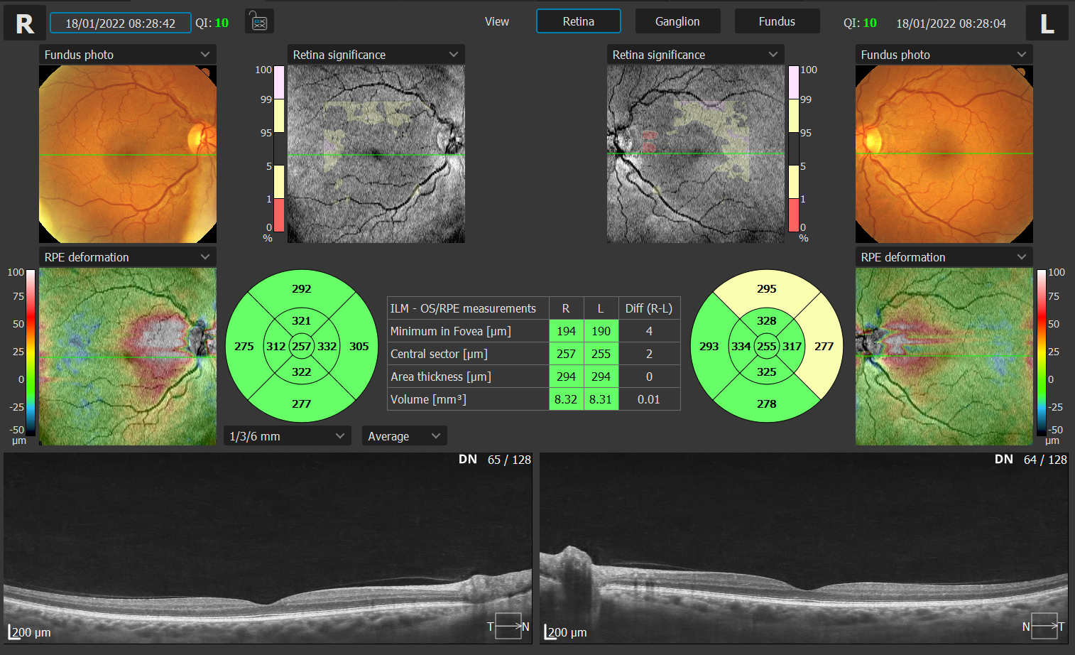 Wallace Opticians | Advanced Equipment | OCT | Retinal Scanning