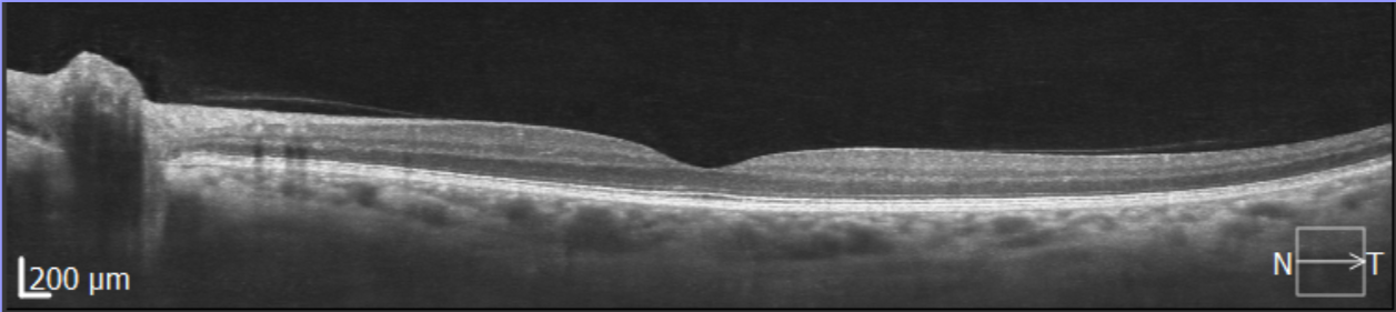 Wallace Opticians - Article - Advanced Retinal Scanning now available