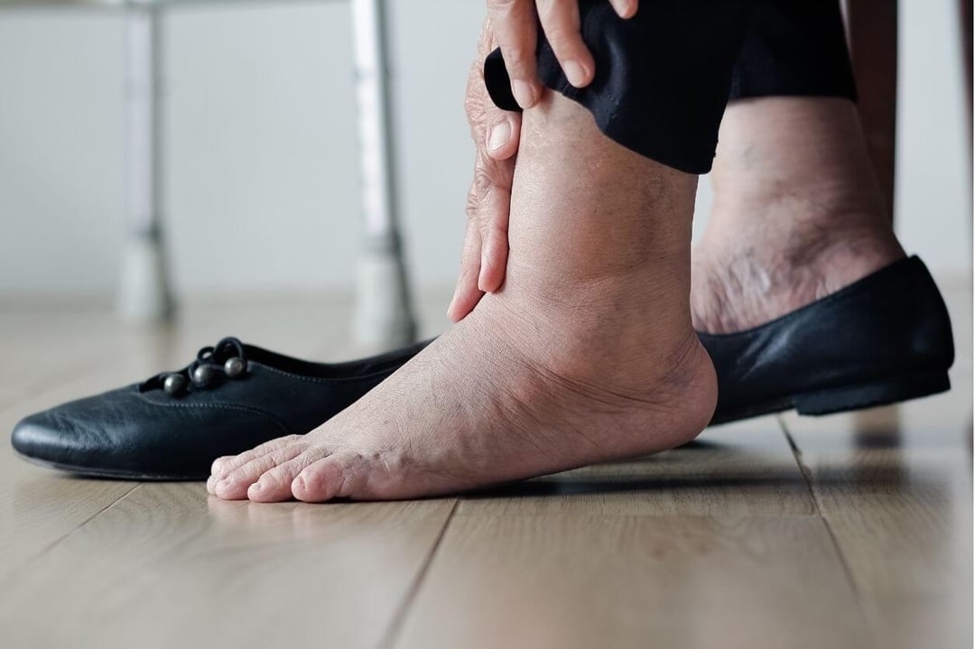 13 Underlying Causes Of Leg Swelling From The Knee Down | Vein Envy™