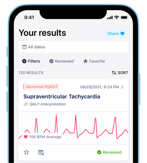 QALY | What a Premature Junctional Contraction (PJC) Looks Like on Your ...
