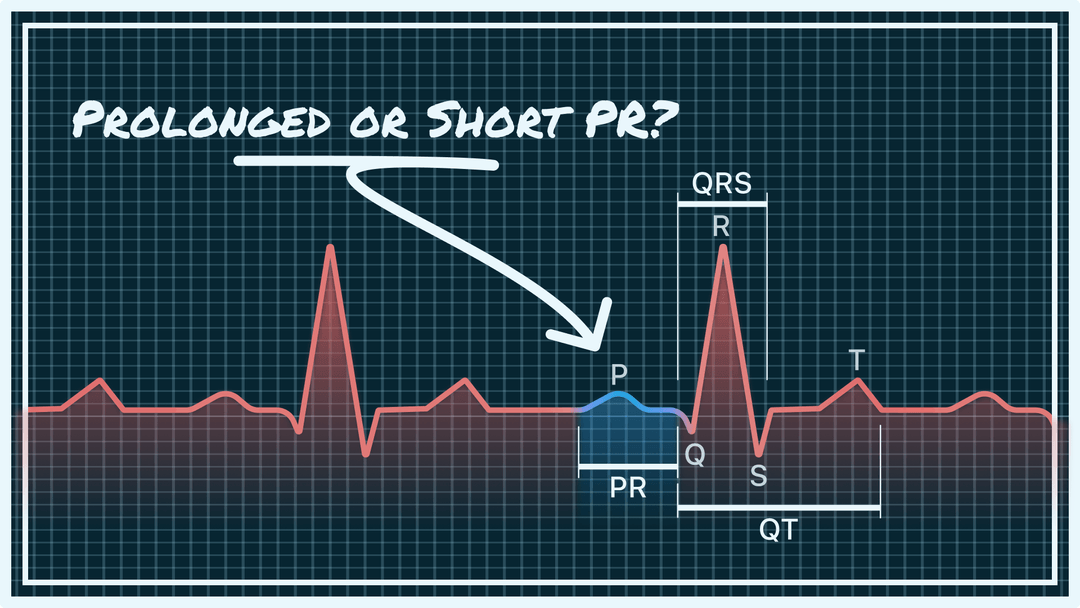 QALY | PR Interval on Your Watch ECG – Short, Normal, and Prolonged